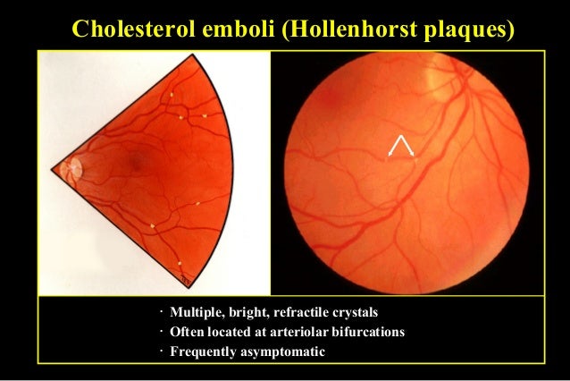 Retinal Vascular occlusion