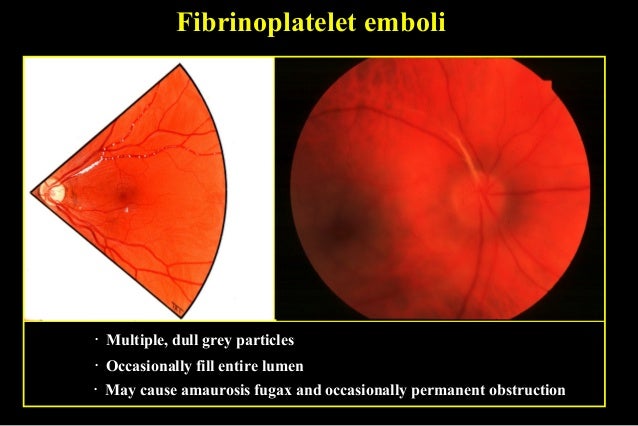 Retinal Vascular occlusion