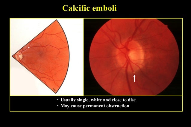 Retinal Vascular occlusion
