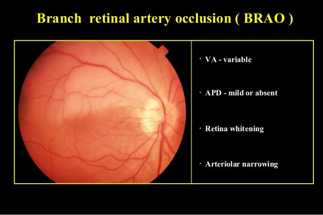 Retinal Vascular occlusion