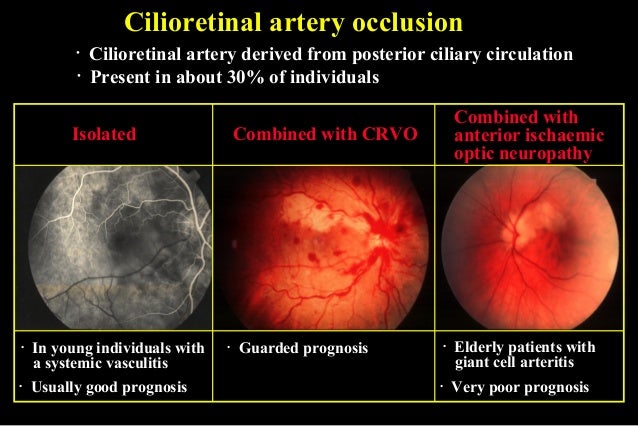 Central Retinal Artery Occlusion Boxcar
