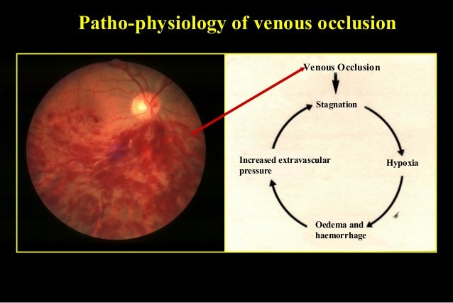 Retinal Vascular occlusion