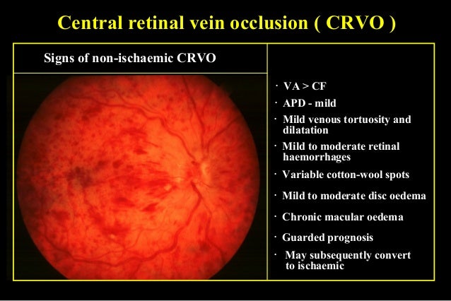 Retinal Vascular occlusion