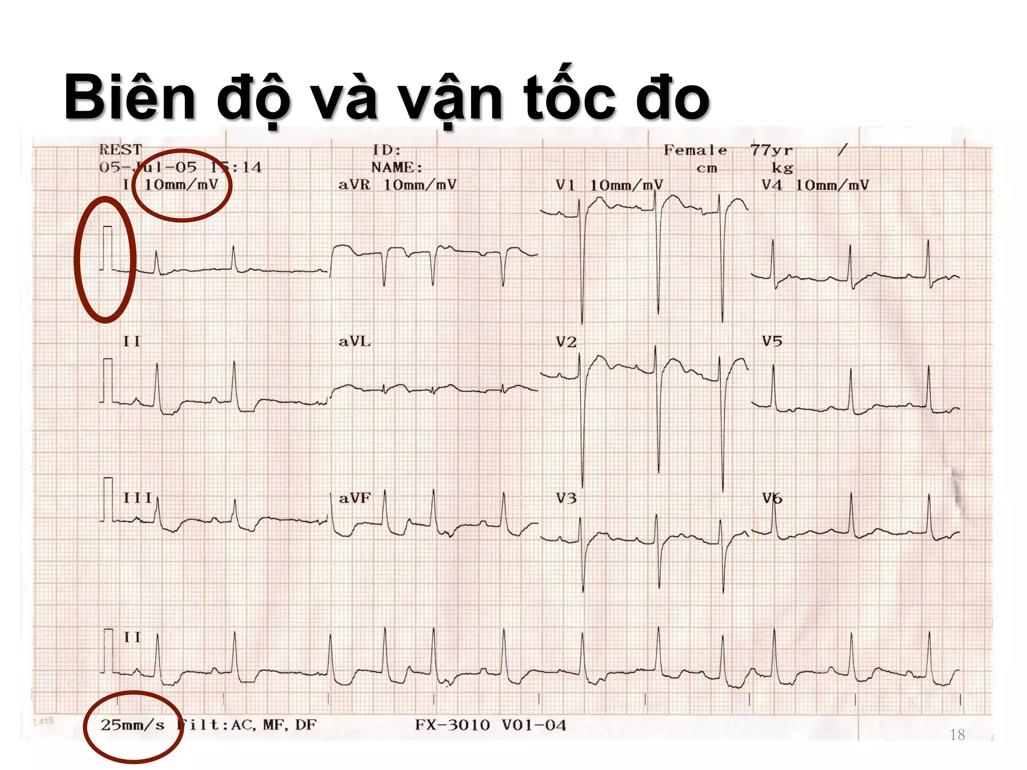CÁC BƯỚC ĐỌC ECG | PDF