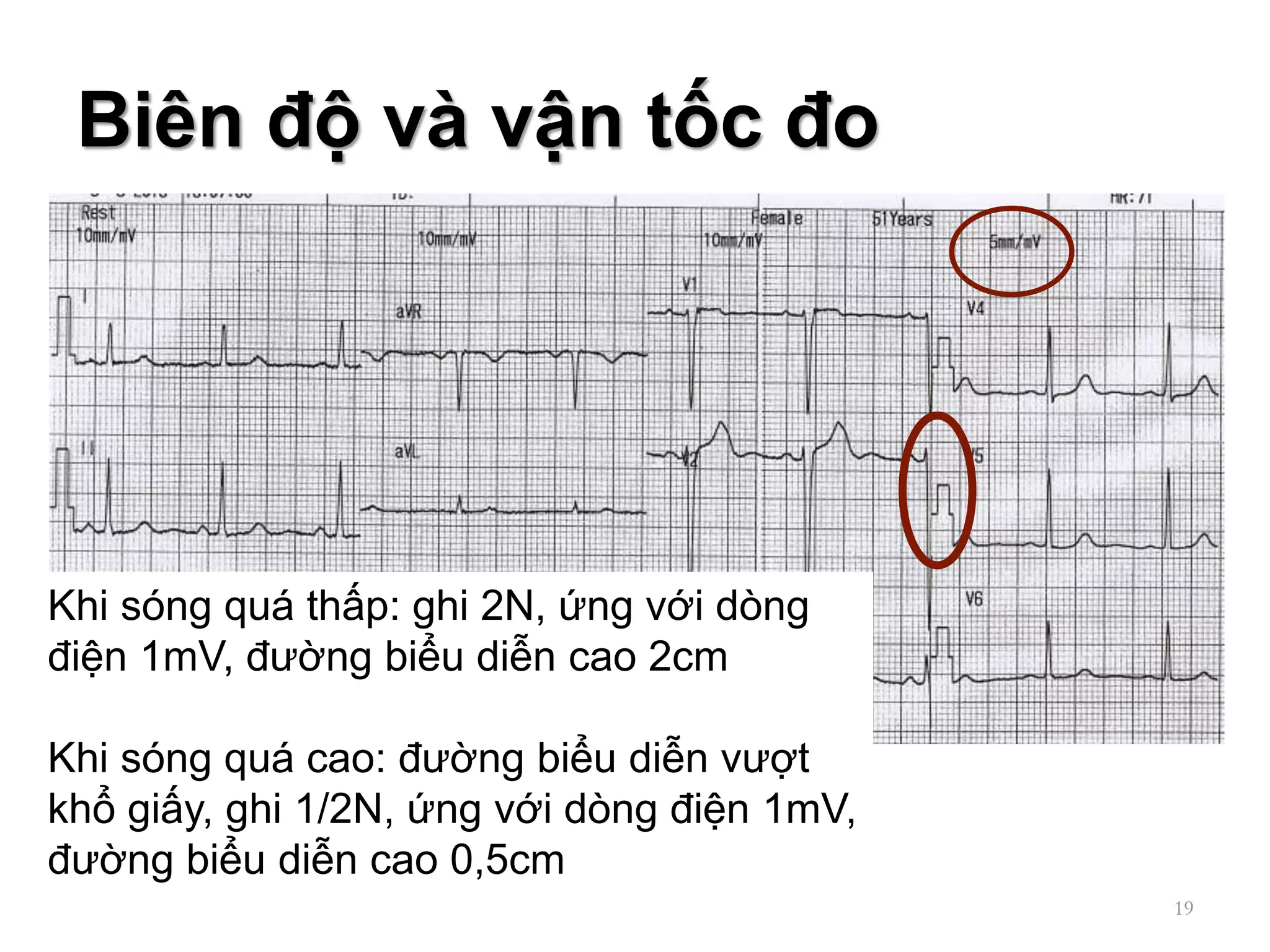 CÁC BƯỚC ĐỌC ECG | PDF