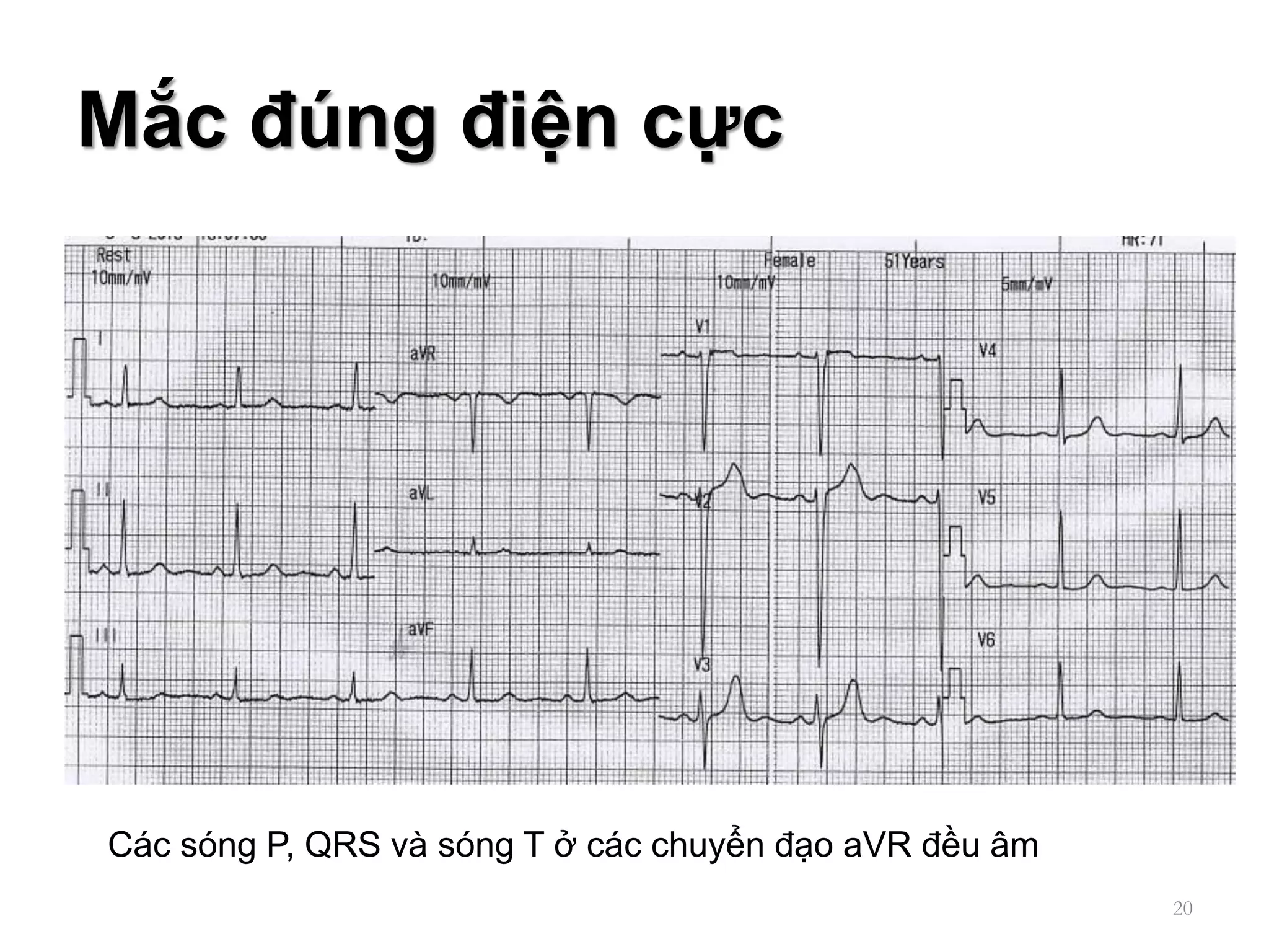 CÁC BƯỚC ĐỌC ECG | PDF