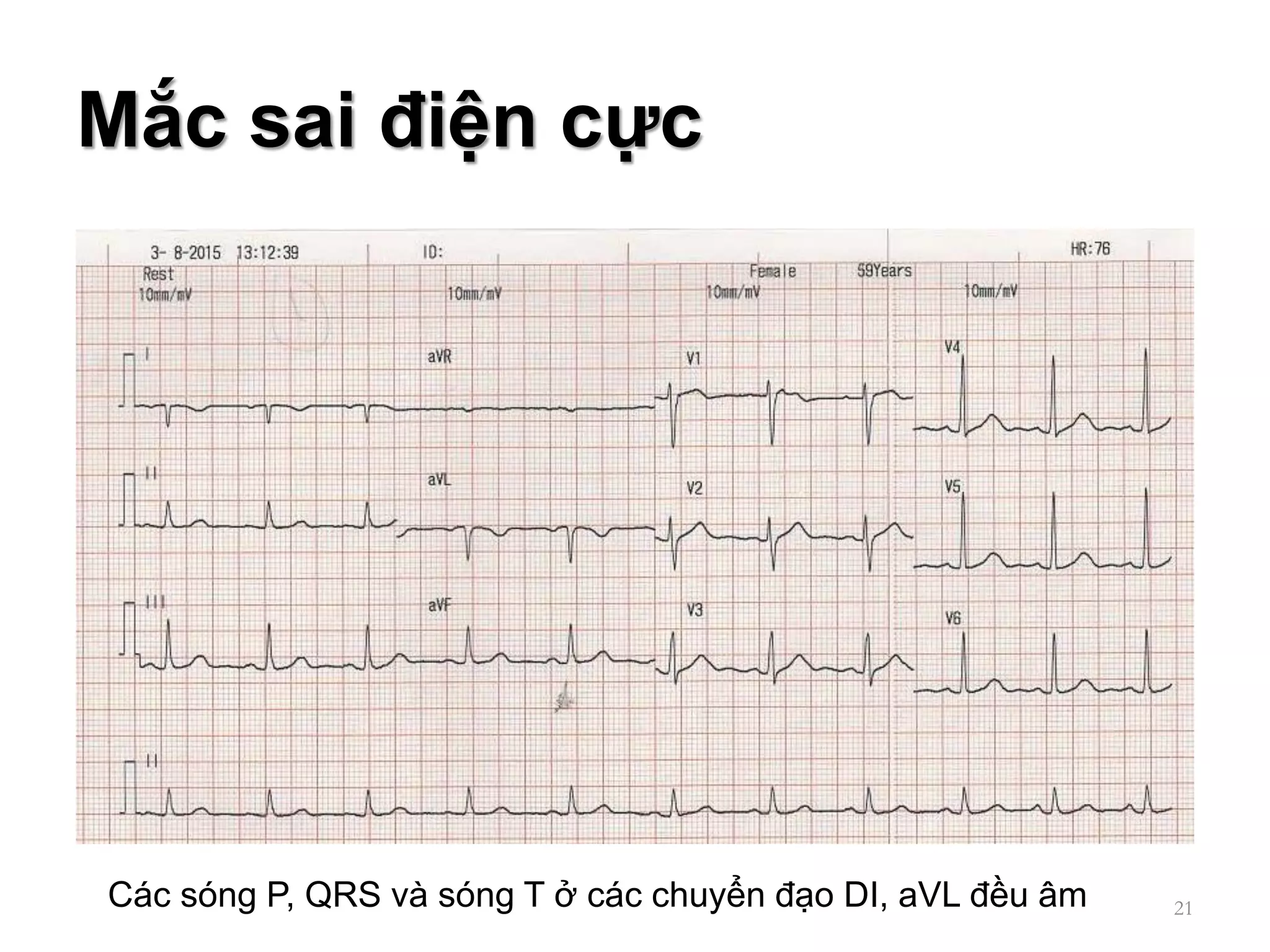 CÁC BƯỚC ĐỌC ECG | PDF