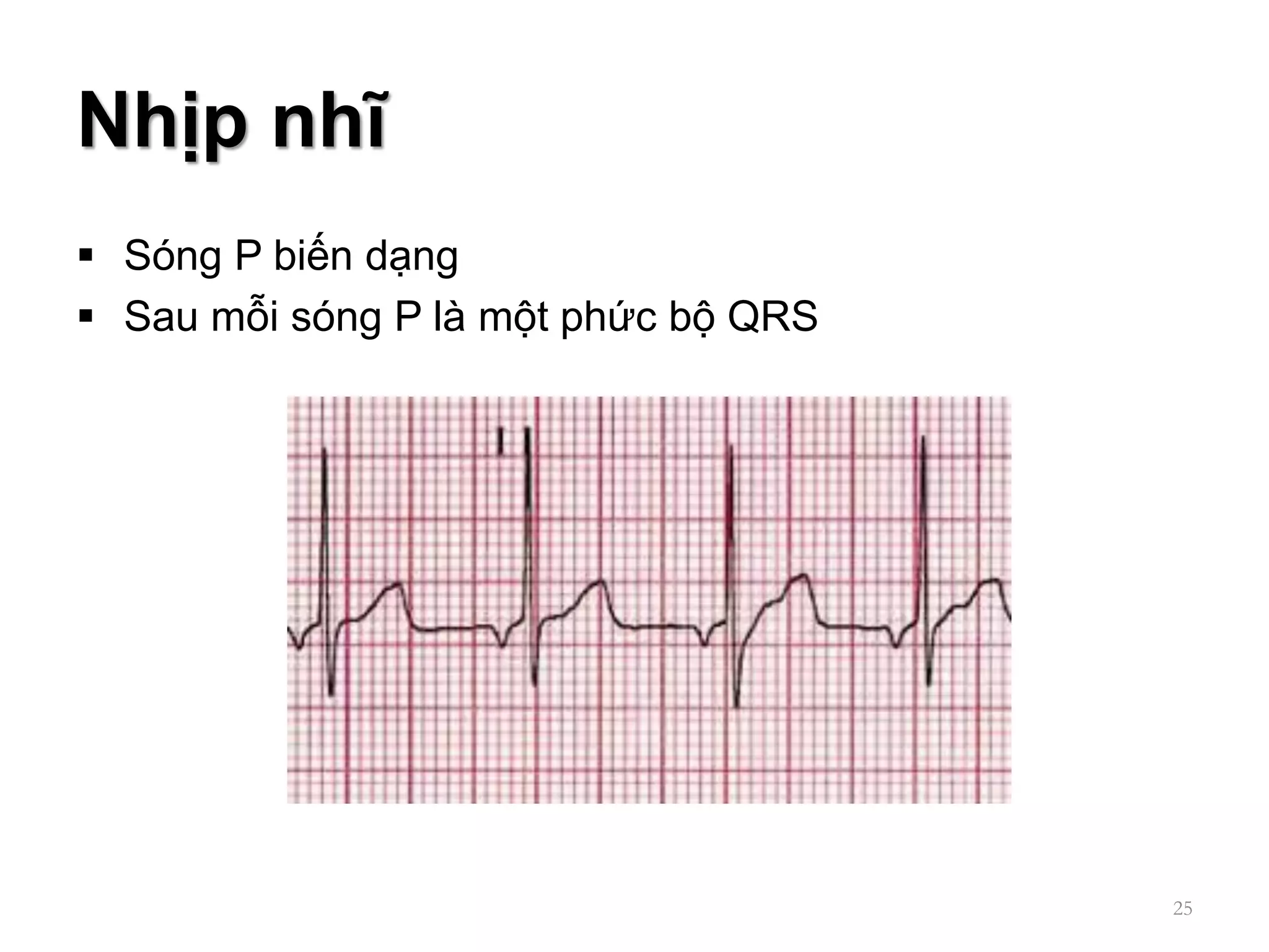 CÁC BƯỚC ĐỌC ECG | PDF