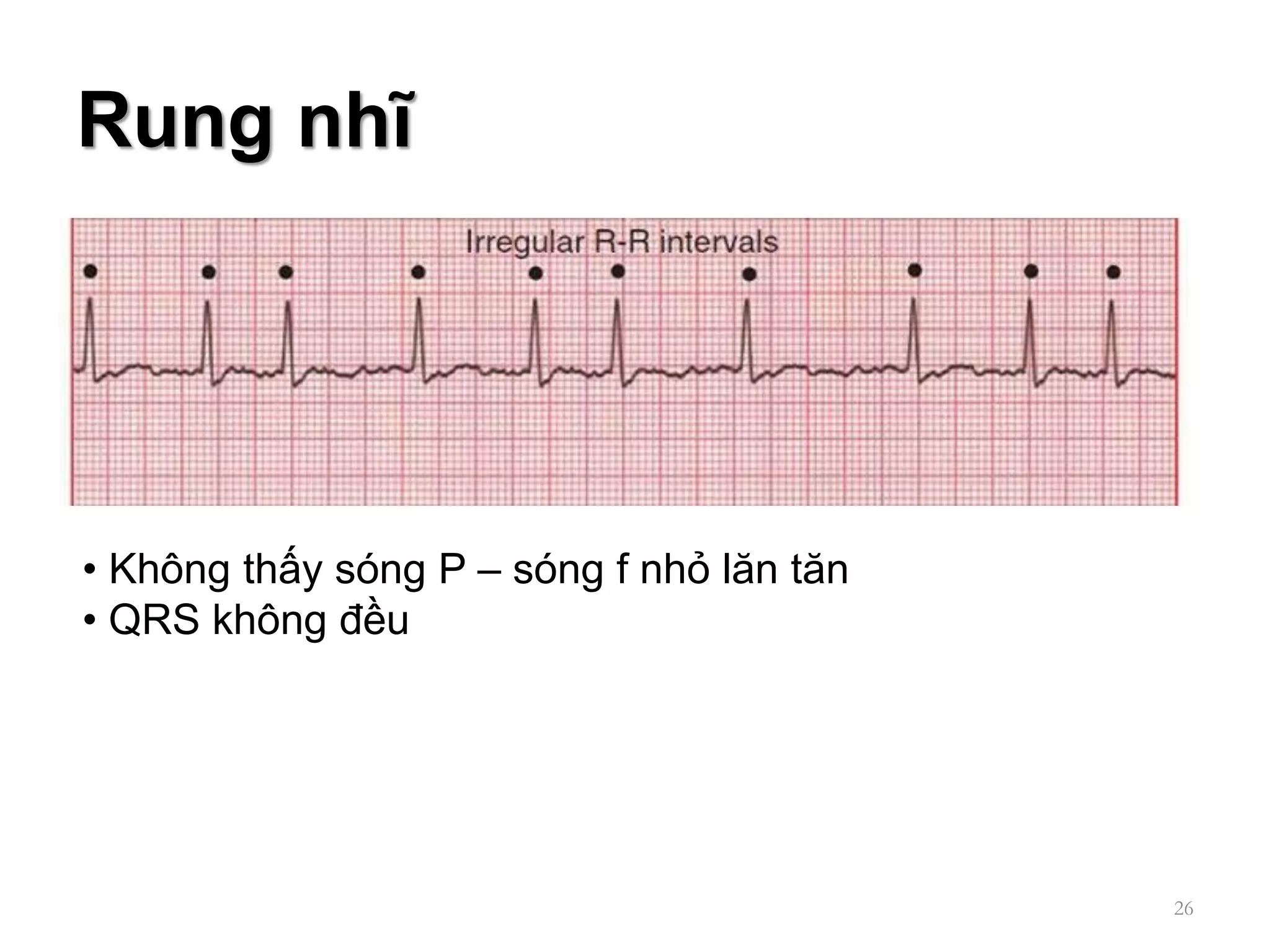 CÁC BƯỚC ĐỌC ECG | PDF