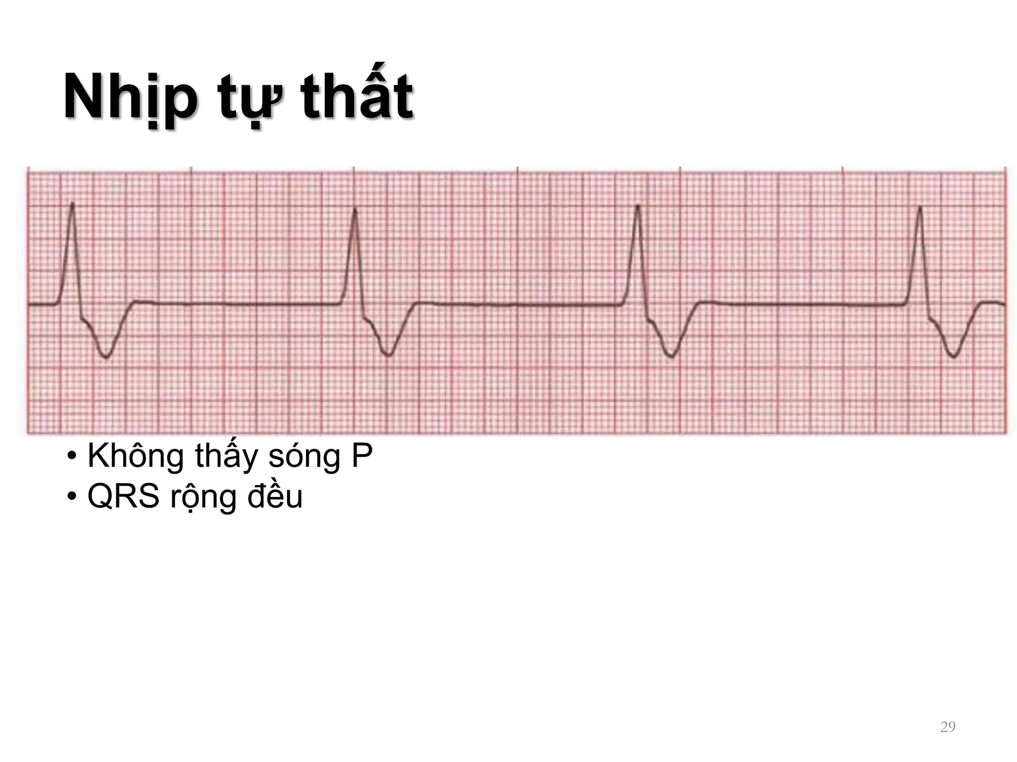 CÁC BƯỚC ĐỌC ECG | PDF