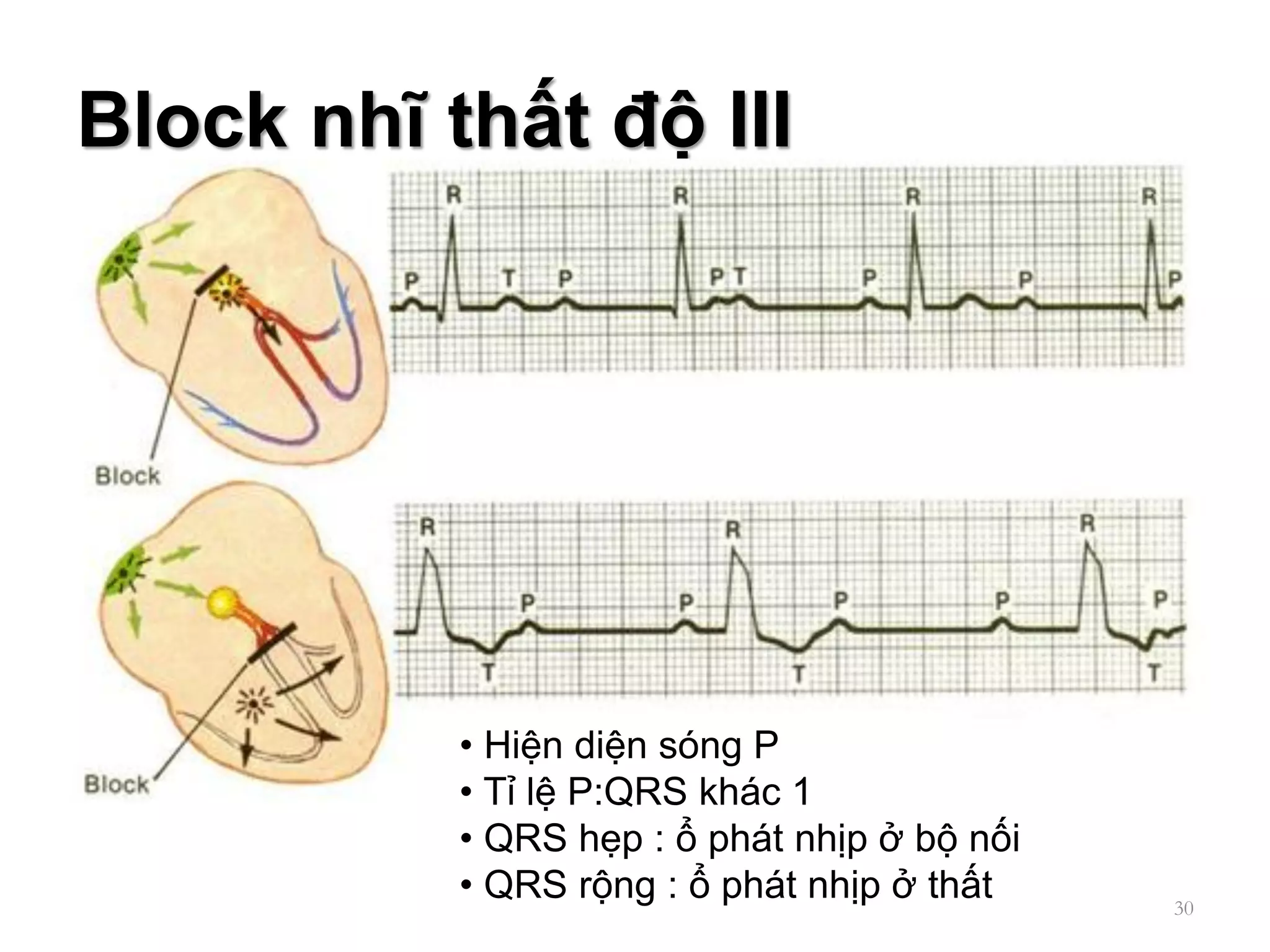 CÁC BƯỚC ĐỌC ECG | PDF