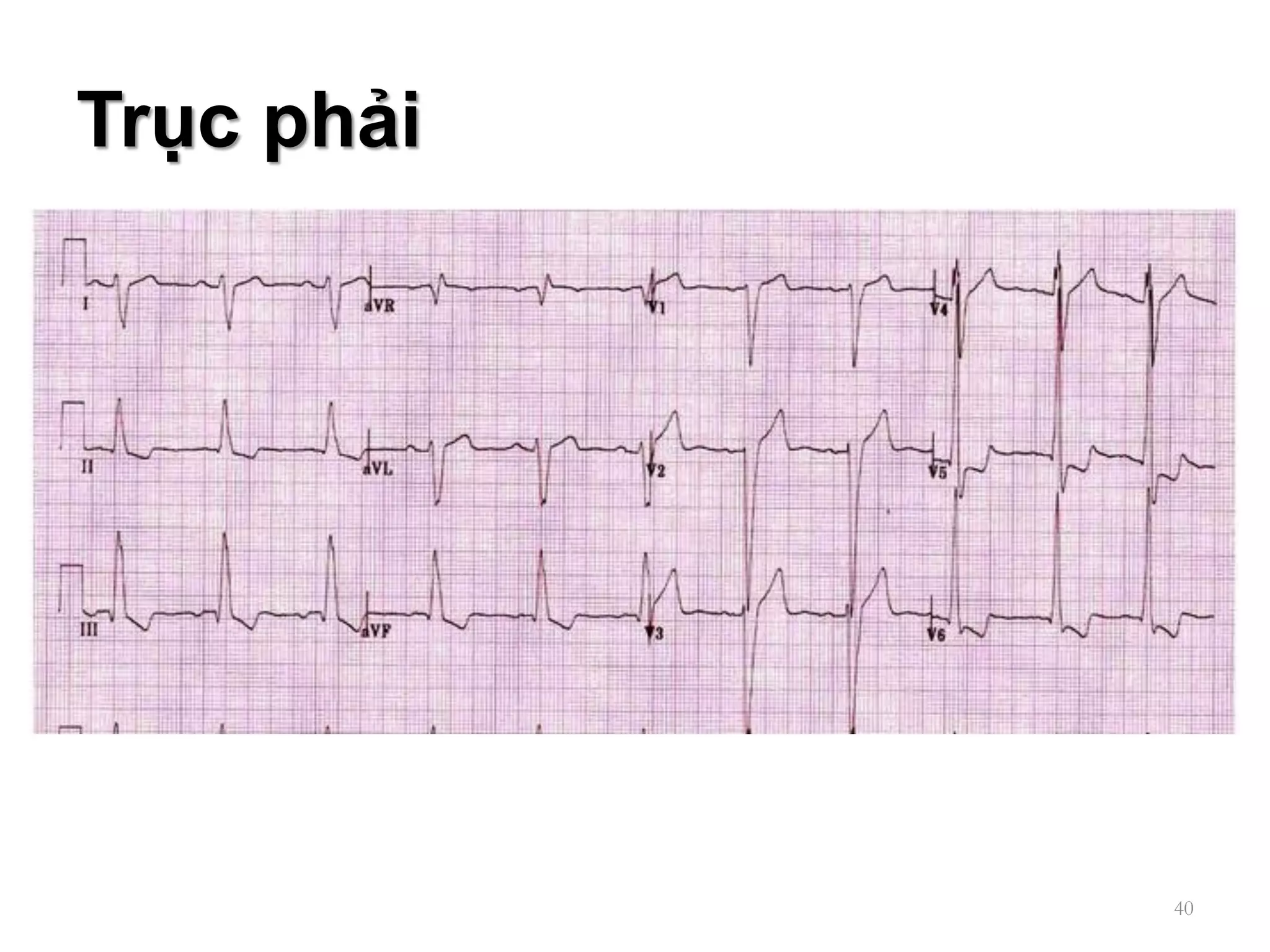 CÁC BƯỚC ĐỌC ECG | PDF