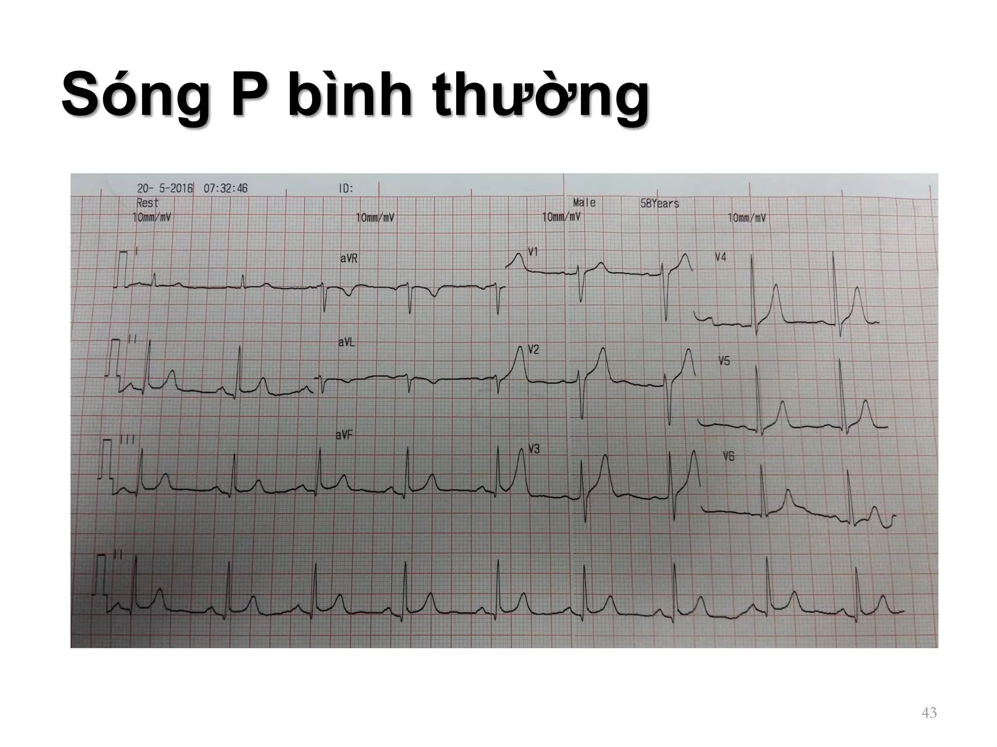 CÁC BƯỚC ĐỌC ECG | PDF