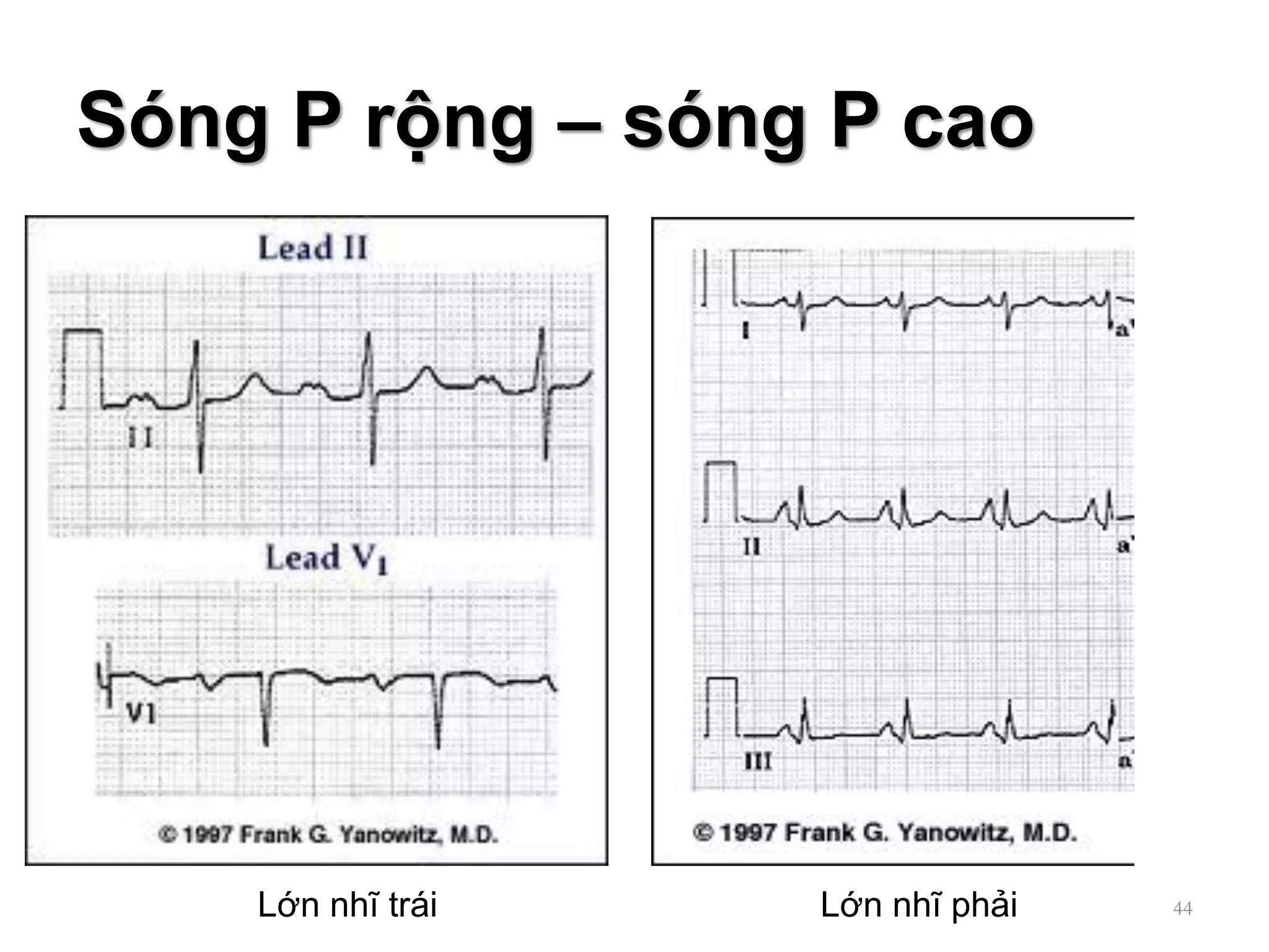 CÁC BƯỚC ĐỌC ECG | PDF
