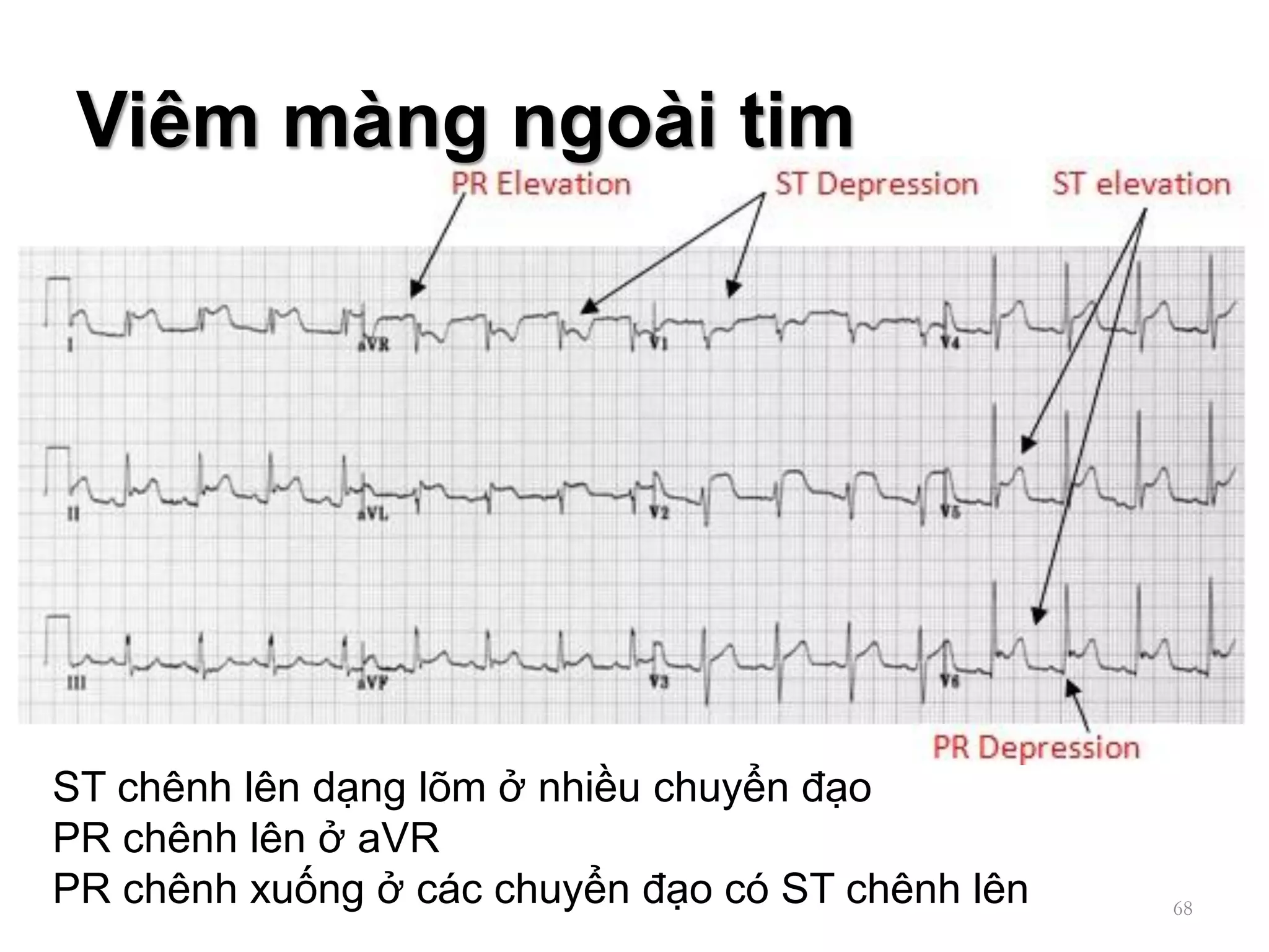 CÁC BƯỚC ĐỌC ECG | PDF