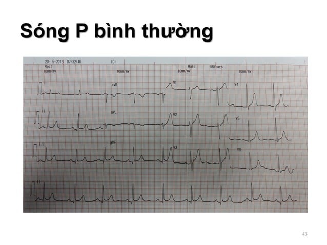 CÁC BƯỚC ĐỌC ECG | PDF