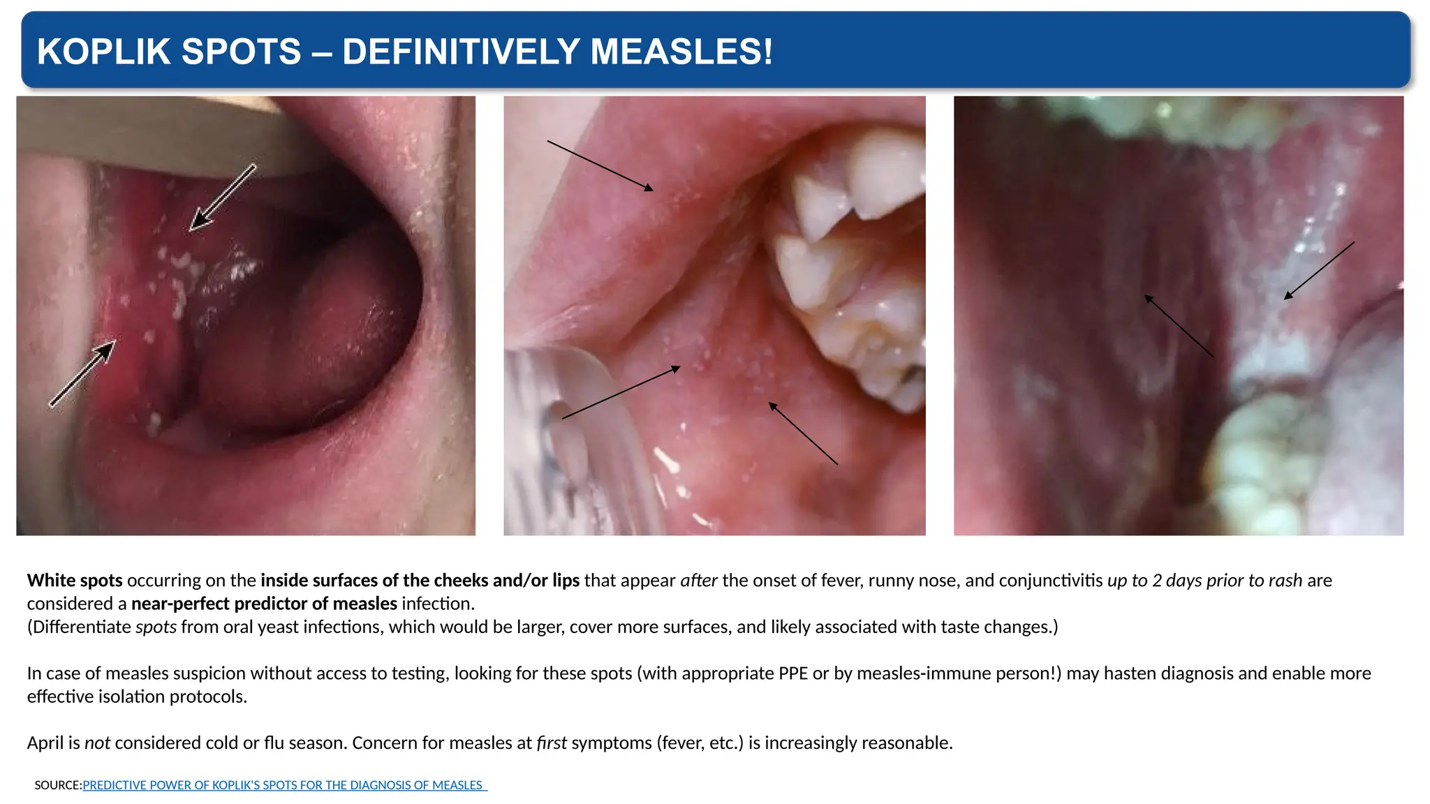 YSPH VMOC Special Report - Measles Outbreak Southwest US 4-6-2025 ver 5 ...