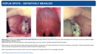 YSPH VMOC Special Report - Measles Outbreak Southwest US 4-8-2025 FINAL ...