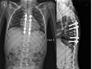 Infective spondylodiscitis case 1 | PPTX