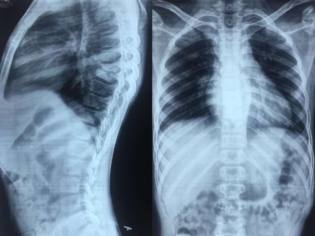 Infective spondylodiscitis case 1 | PPT