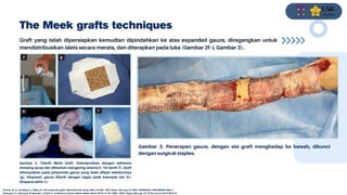 YUD Burn 2 Meek micrografting history, indications, technique ...