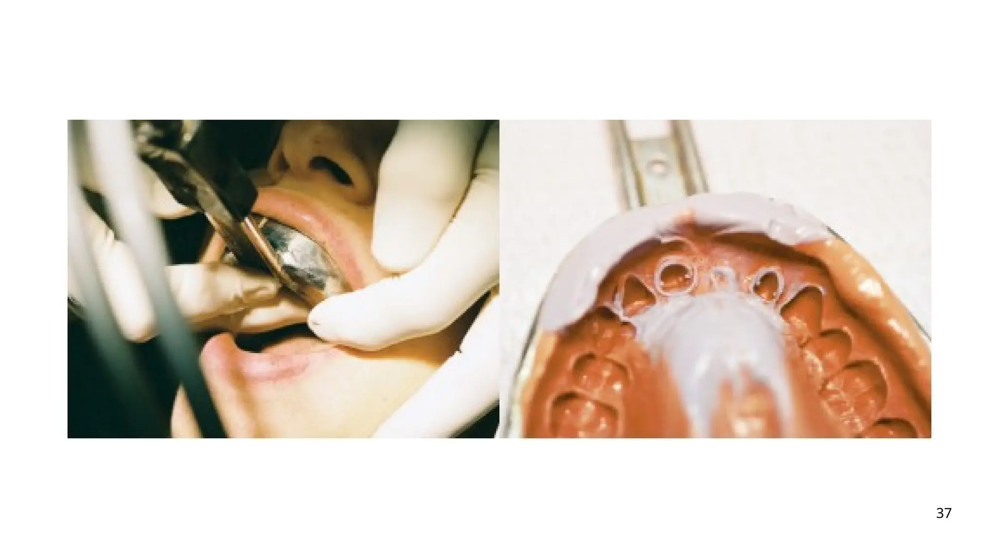 Impression Techniques used for fixed partial Denture | PPT