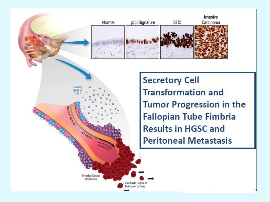 Prophylactic Salpingectomy