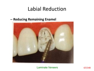 Laminates & Veneers | PPTX