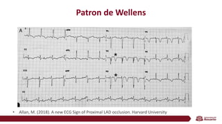 Electrocardiograma | PPTX
