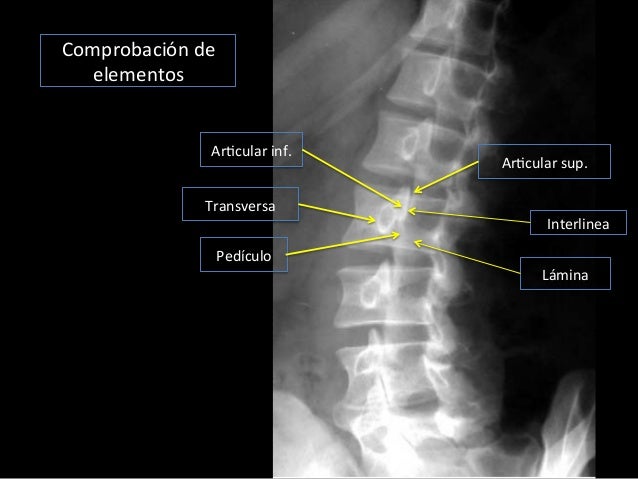 Rx de la región lumbar y la pelvis