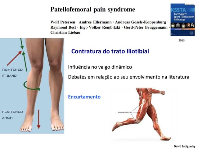 Síndrome Femoropatelar