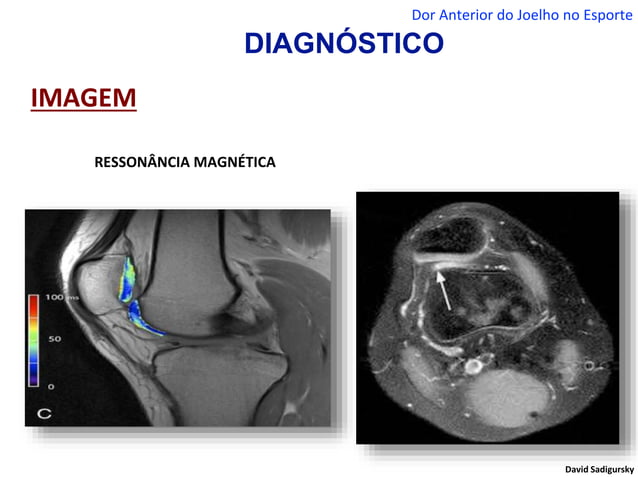 Síndrome Femoropatelar | PPT