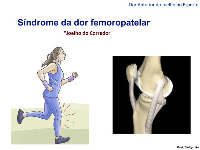 Síndrome Femoropatelar