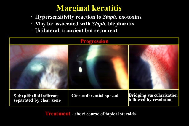 13 peripheral corneal inflam