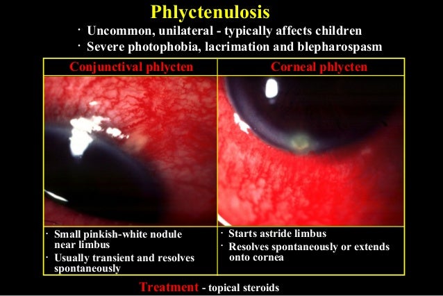13 peripheral corneal inflam