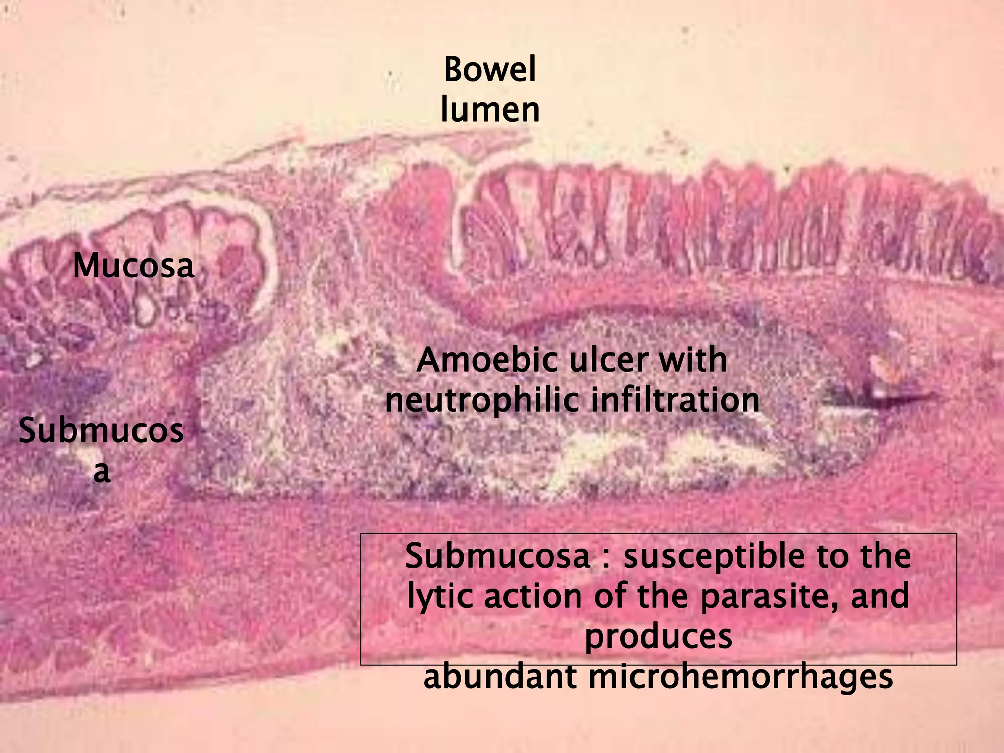 Intestinal and extraintestinal amoebiasis | PPTX