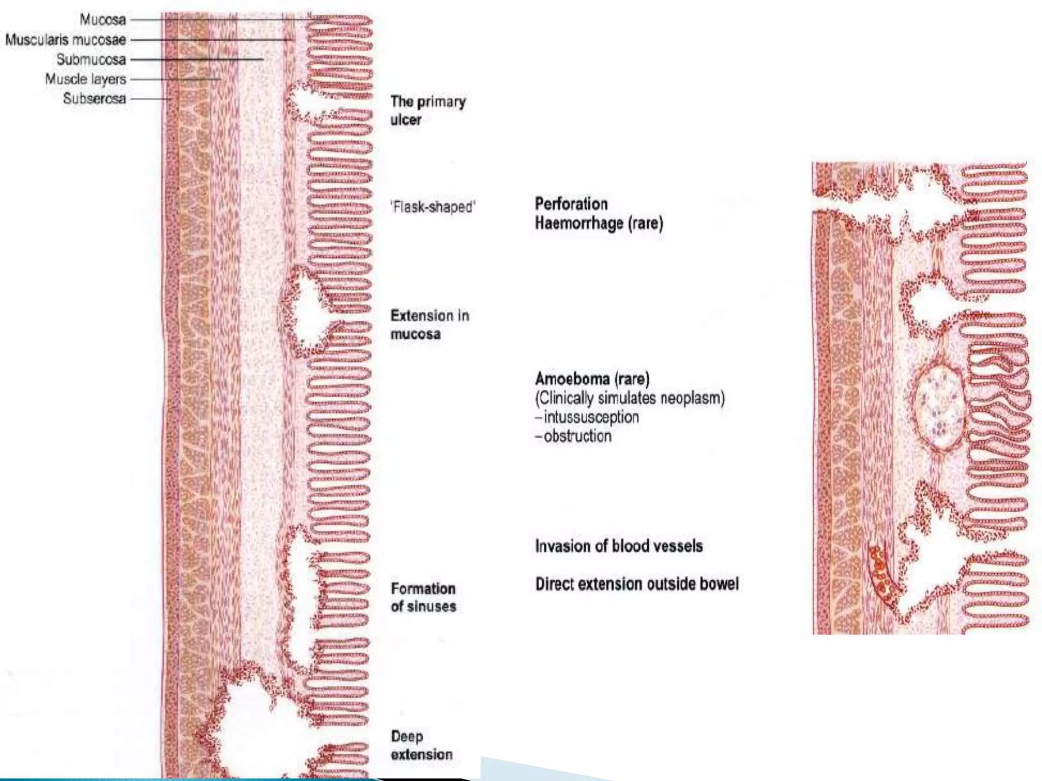 Intestinal and extraintestinal amoebiasis | PPTX