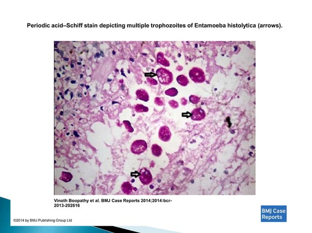 Intestinal and extraintestinal amoebiasis | PPTX | Digestive Disorders ...