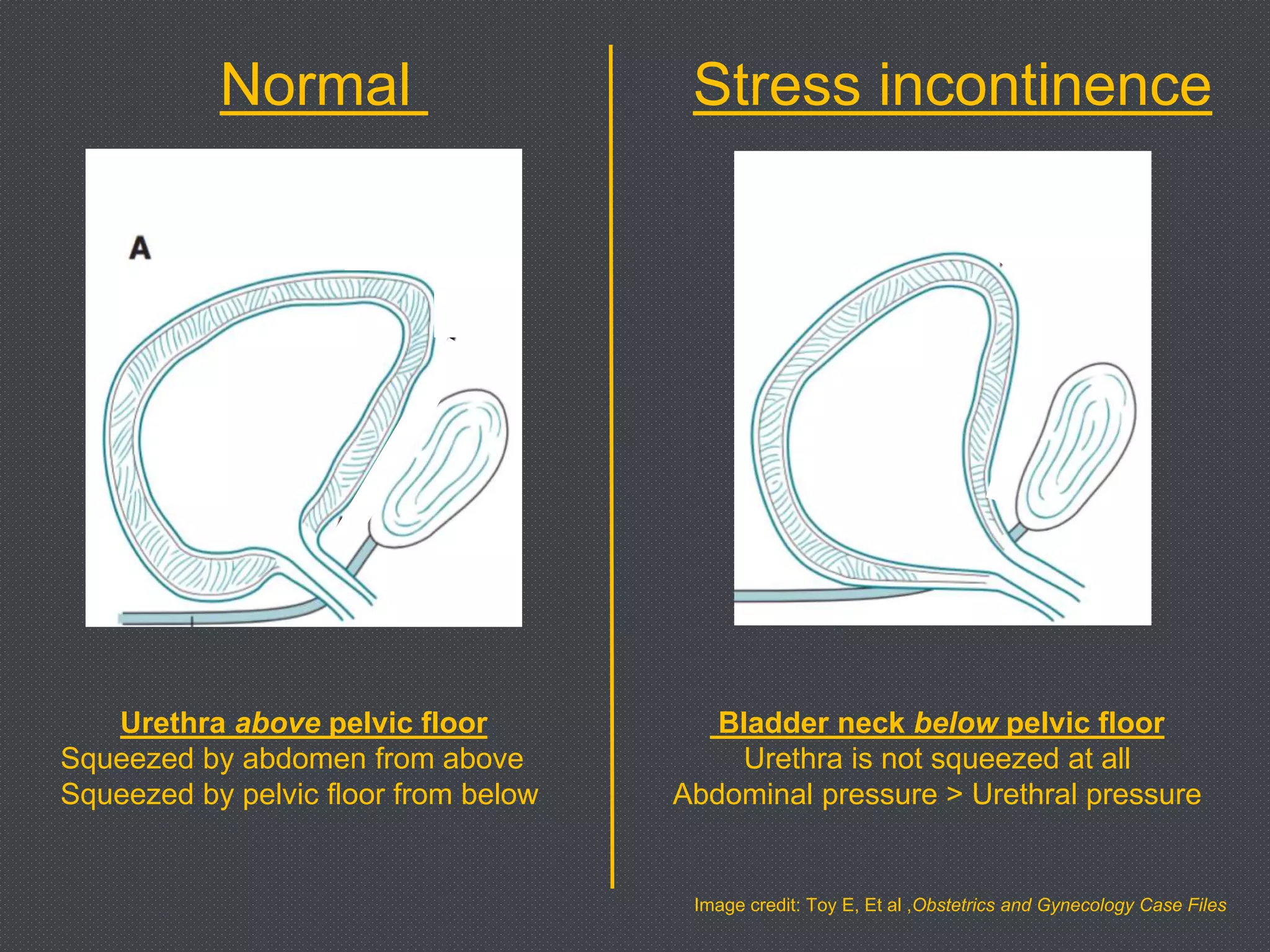 Urinary Incontinence | PPTX