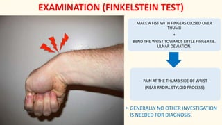 DE QUERVAIN'S TENOSYNOVITIS | PPTX
