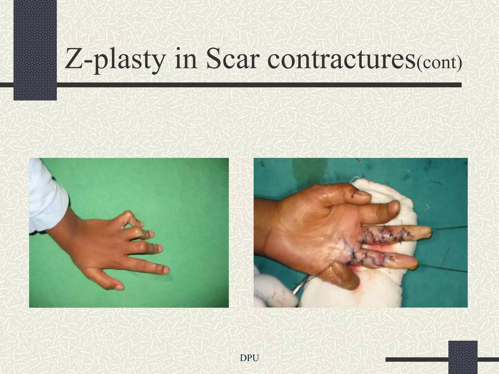 Z plasty | PPTX