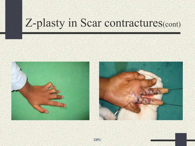 Z plasty | PPTX | Ear, Nose and Throat Conditions | Diseases and Conditions
