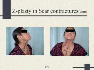 Z plasty | PPTX | Ear, Nose and Throat Conditions | Diseases and Conditions
