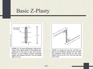 Z plasty | PPTX