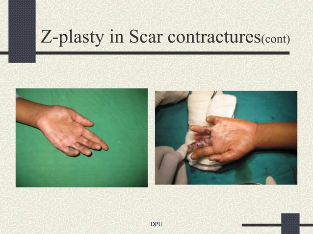Z plasty | PPTX | Ear, Nose and Throat Conditions | Diseases and Conditions