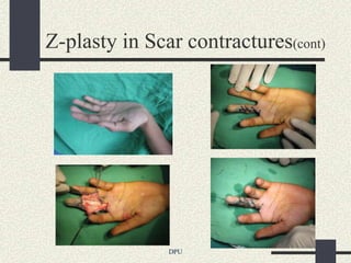 Z plasty | PPTX | Ear, Nose and Throat Conditions | Diseases and Conditions