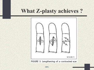 Z Plasty