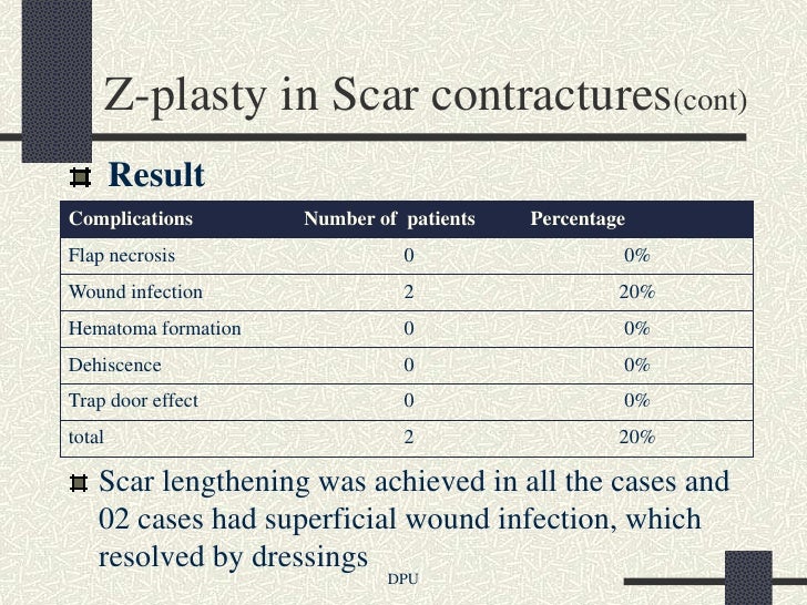 Z Plasty