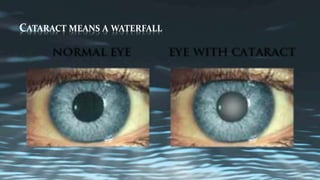 Laser Cataract Surgery the new method to treat cataracts | PPTX