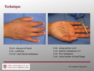 Fat Transfer to the Upper and Lower Extremities in Patients with ...